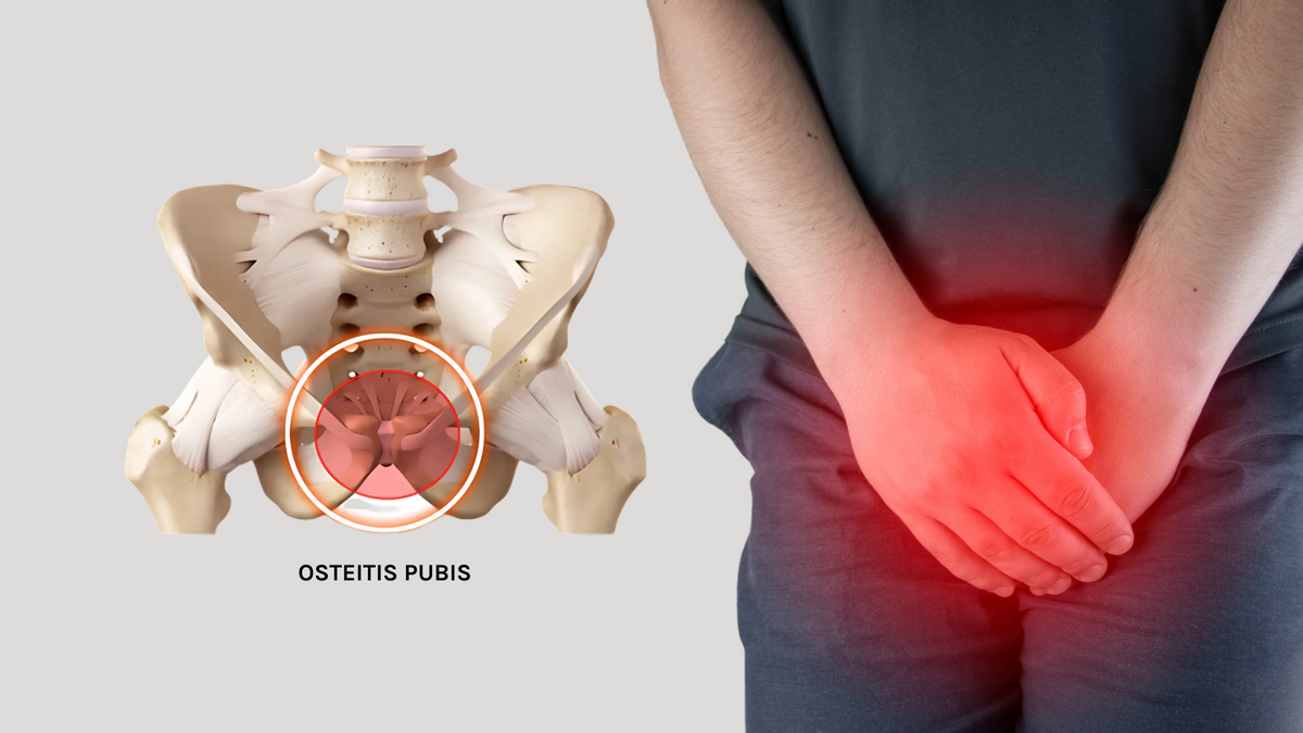 Osteitis Pubis Supacore 8304